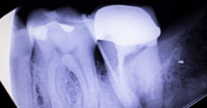 What to Do When You Have a Half-Broken Molar Tooth? - Health Report