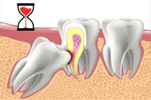 What Are The First Signs of Wisdom Teeth Coming In? - Health Report