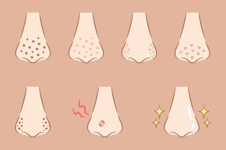 What Are Nose Bumps At Gail Carroll Blog What Are Nose Bumps At Gail Carroll Blog